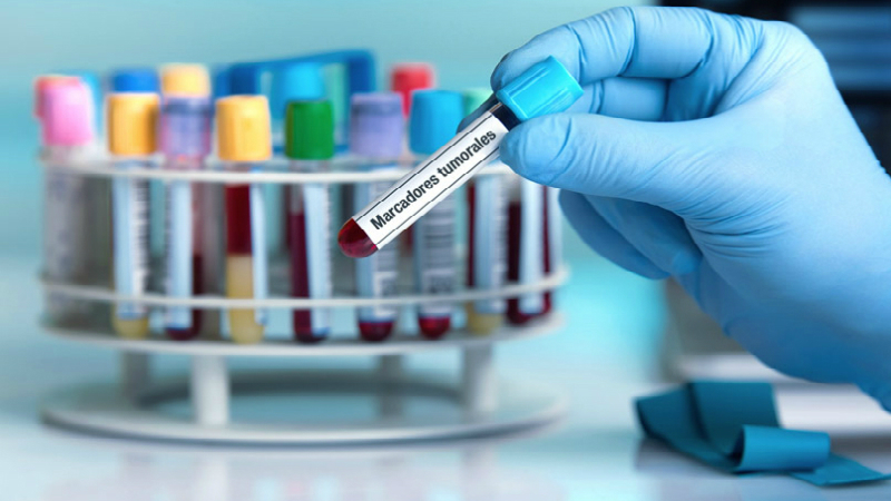 Diagnóstico del cáncer: marcadores tumorales | OCU
