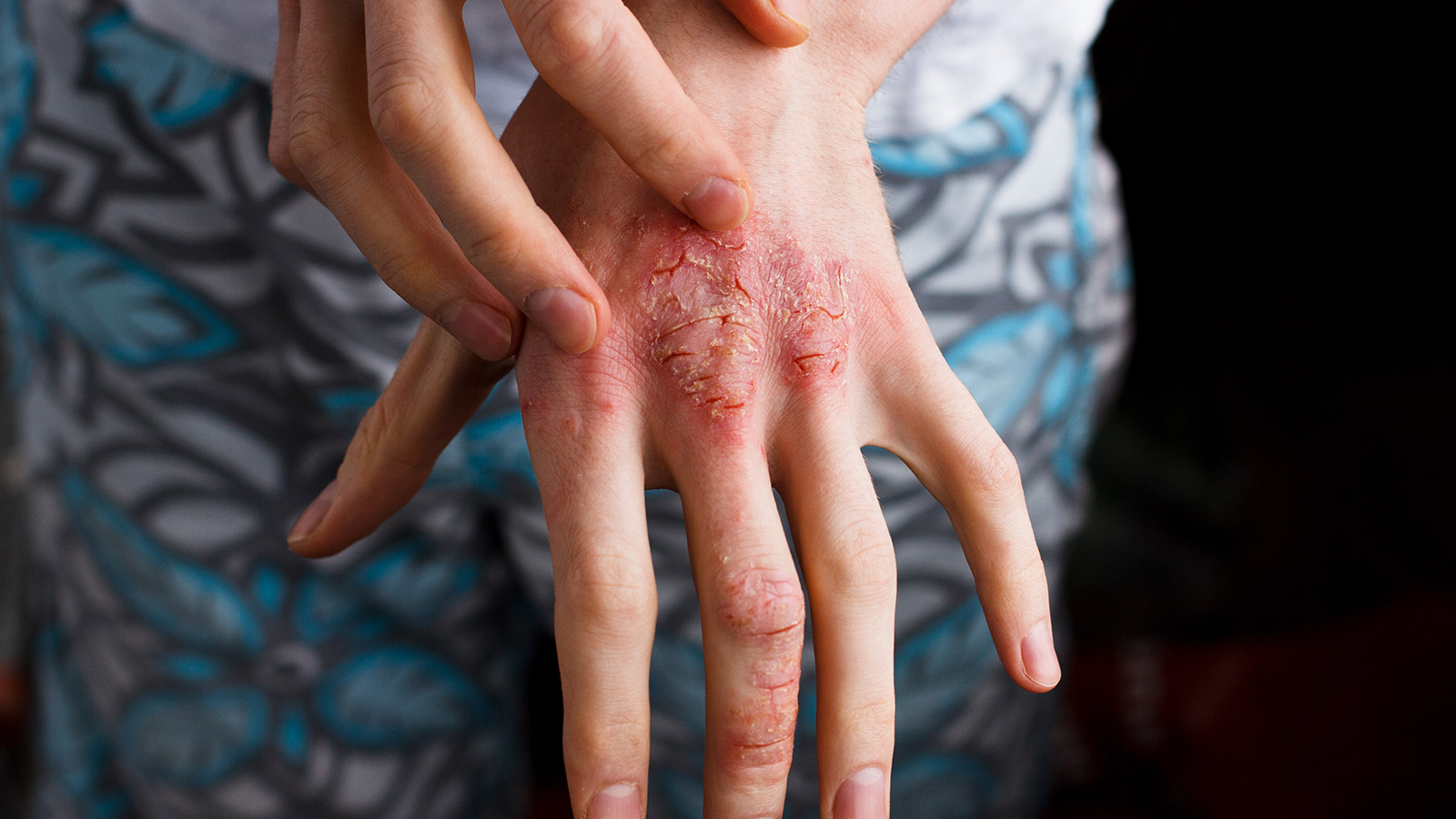 Psoriasis, tipos y tratamientos | OCU