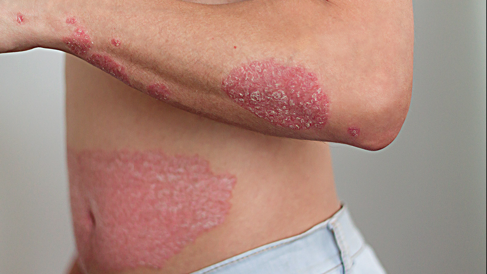 Psoriasis, tipos y tratamientos | OCU