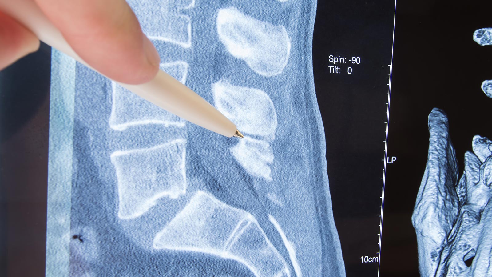 Ciática causas y tratamiento | OCU
